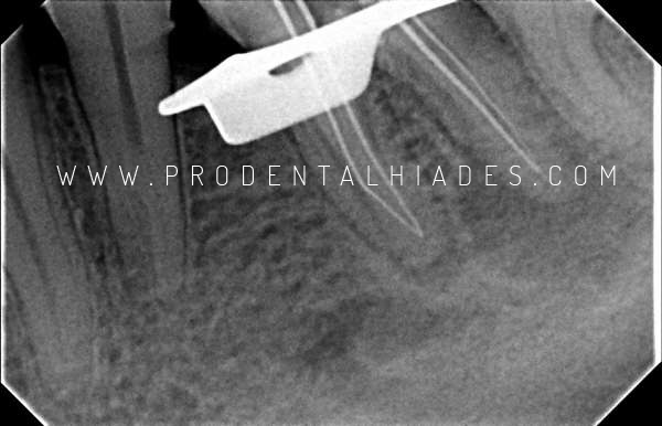 Endodoncia clinica dental Prodental Hiades