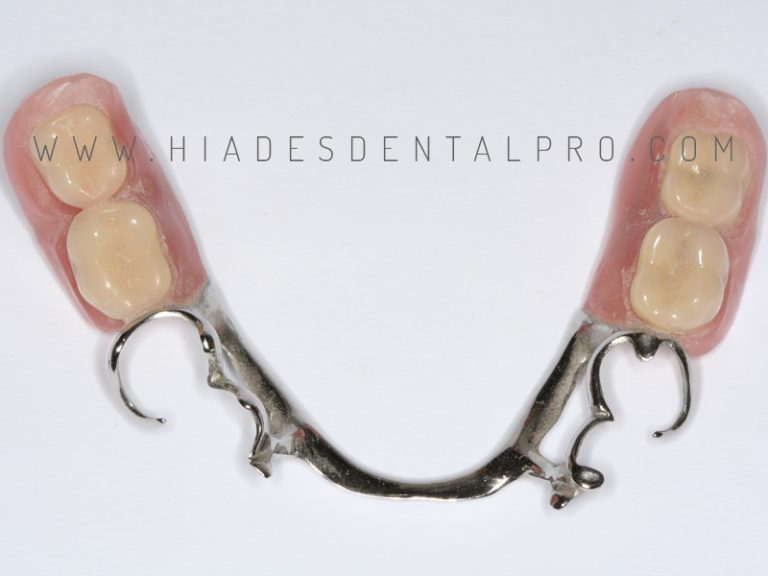 prótesis parcial removible metálica - Clínica Dental Prodental Híades