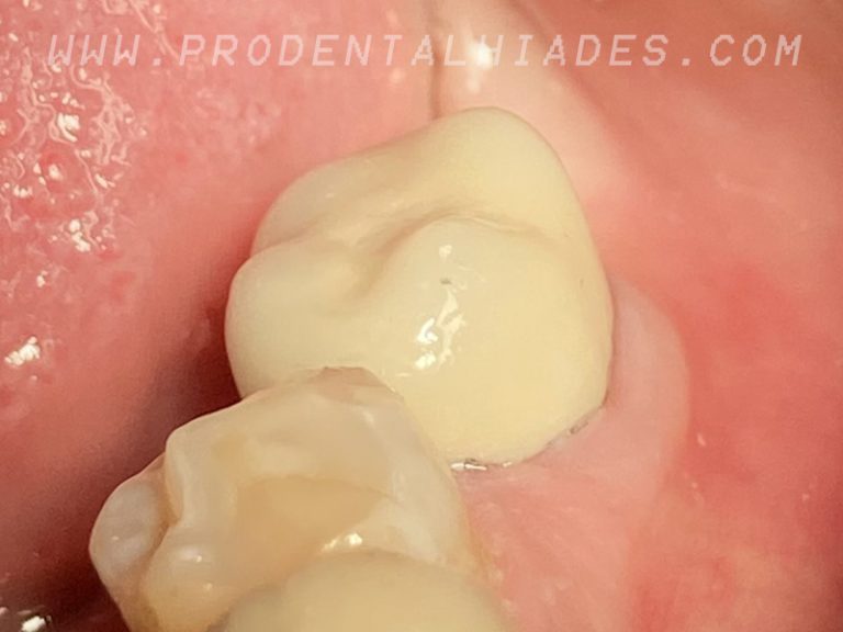 Colocación de corona metal-cerámica - Clínica Dental Prodental Híades